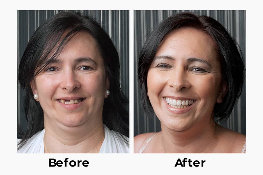 Teeth Implants In Turkey Fill In The Blanks With The Best
