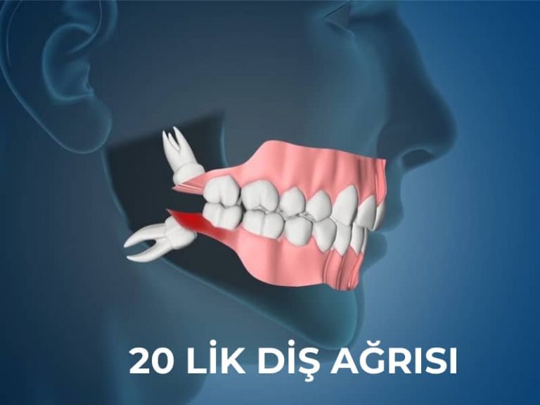 20’lik Diş Ağrısı Nedir? 20’lik Diş Ağrısı Nasıl Geçer? 20’lik Diş Ağrısı Nedir? 20’lik Diş Ağrısı Nasıl Geçer?